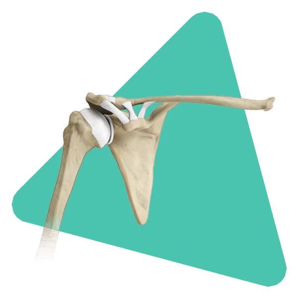 Shoulder Fracture - Polygon PT
